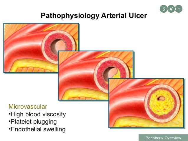 Peripheral Artery Ulcer