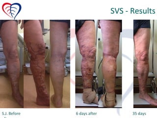 Steam Vein Ablation is safe and efficacious | PPT