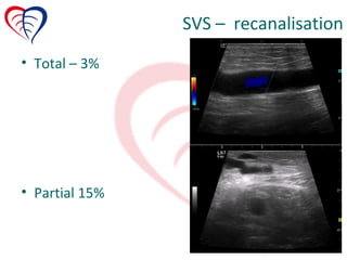 Steam Vein Ablation is safe and efficacious | PPT