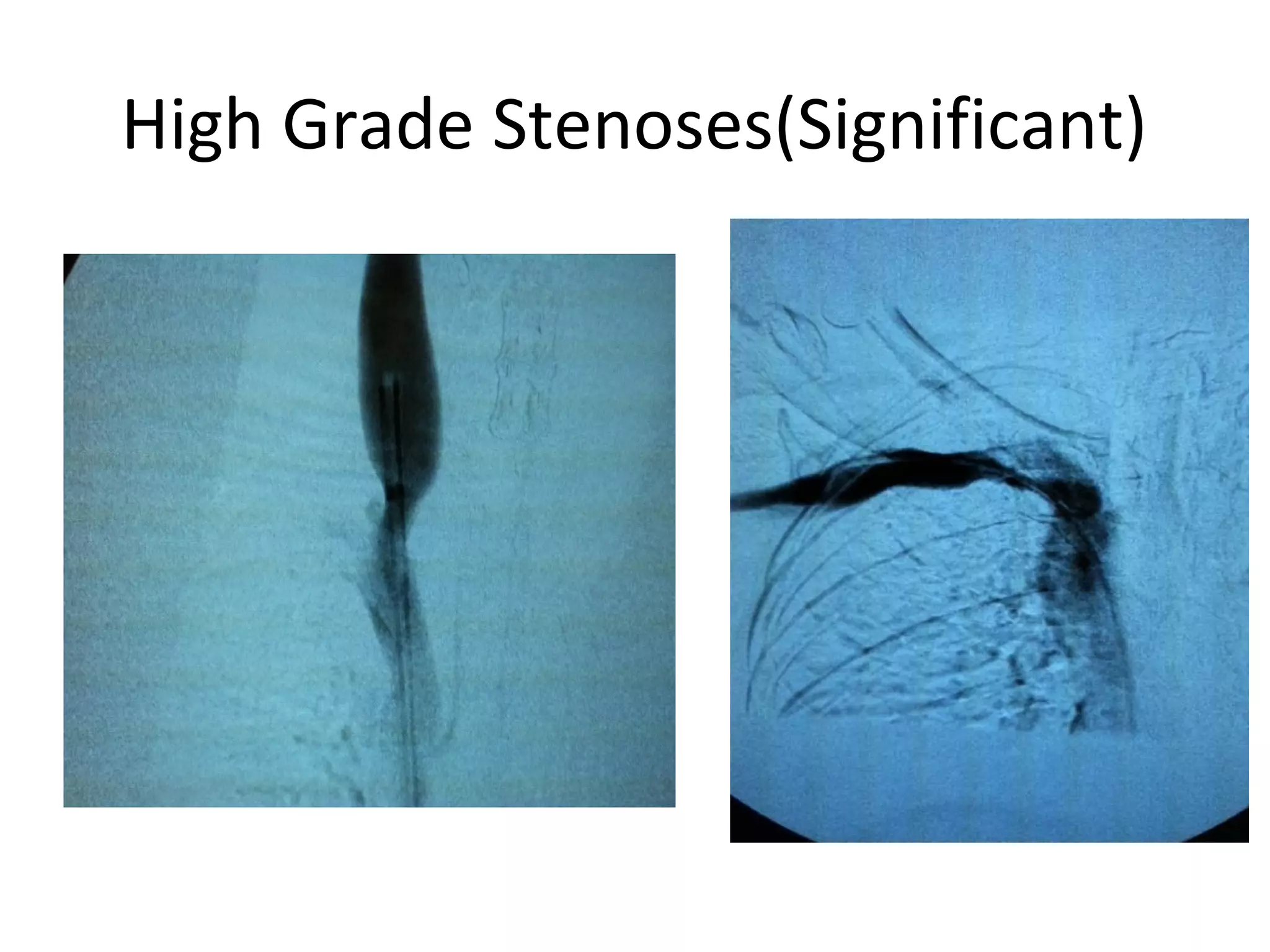 SVS- Thoracic Outlet Syndrome Presentation | PPT | Death, Injury, or ...