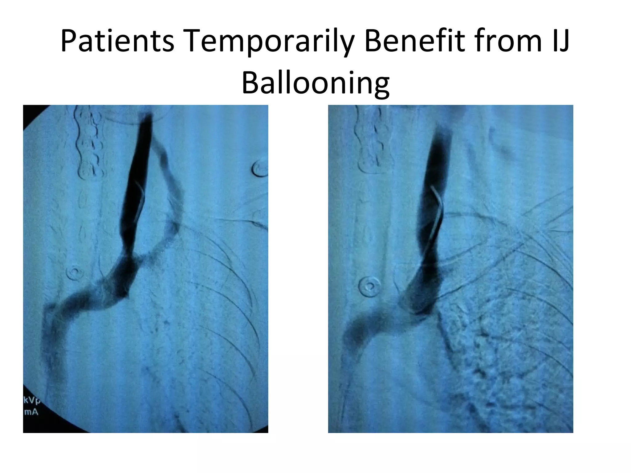 SVS- Thoracic Outlet Syndrome Presentation | PPT | Death, Injury, or ...