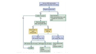 Supraventricular Tachycardia (SVT) Presentation | PPTX