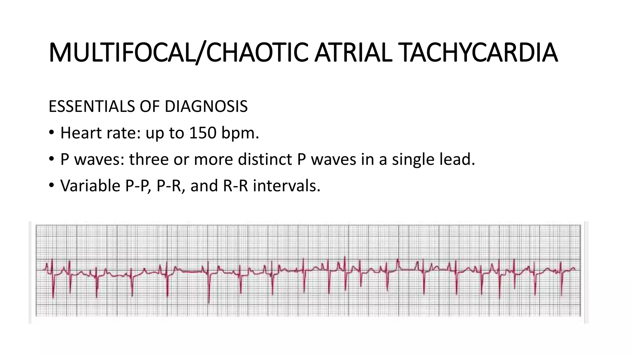 SUPRAVENTRICULAR TACHYCARDIA - SVT | PPTX