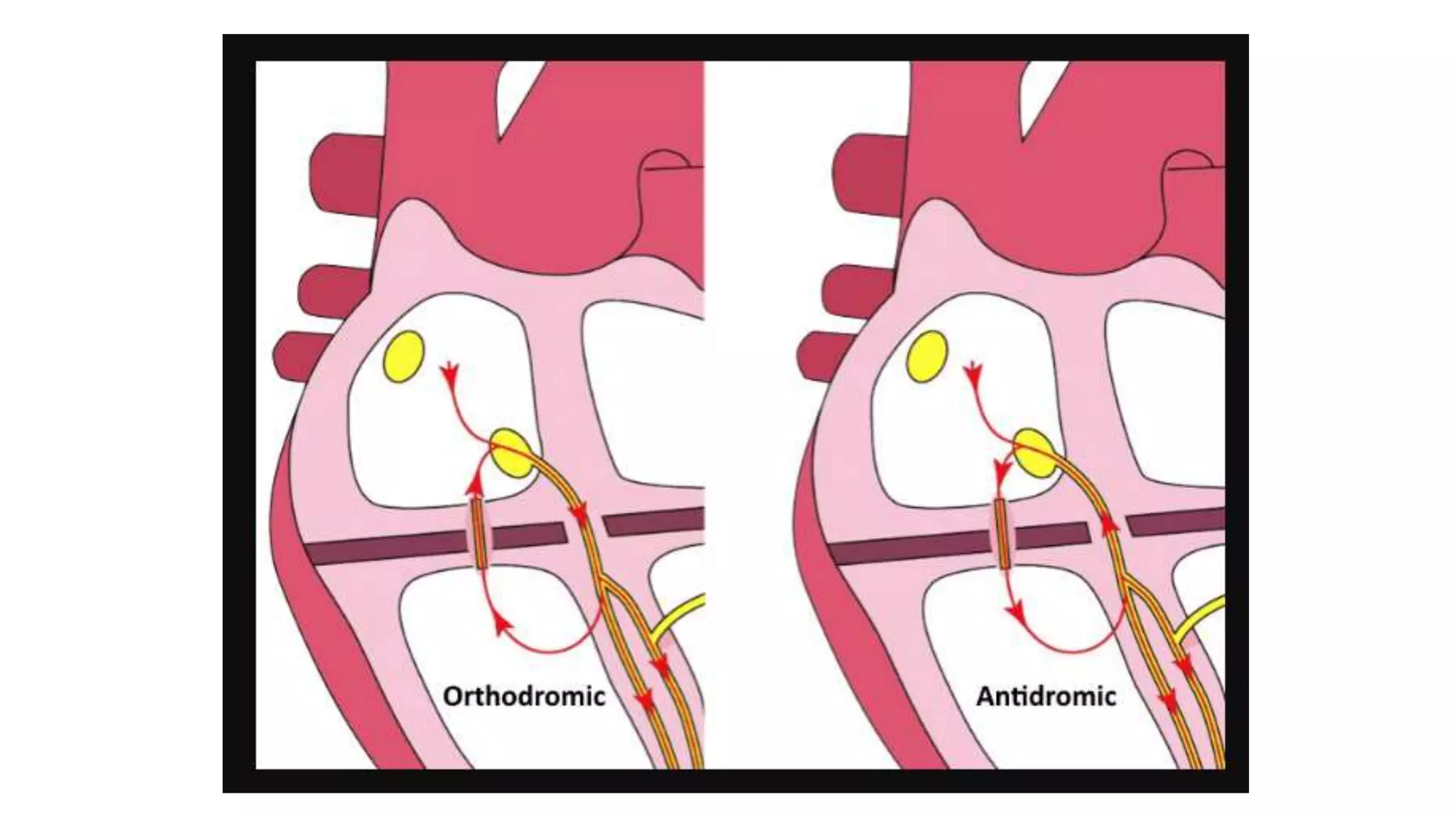 SUPRAVENTRICULAR TACHYCARDIA - SVT | PPTX