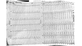 SUPRAVENTRICULAR TACHYCARDIA - SVT | PPTX