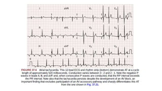 SUPRAVENTRICULAR TACHYCARDIA - SVT | PPT