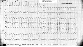 Supraventricular Tachycardia Bmj Atrial Sketch Coloring Page