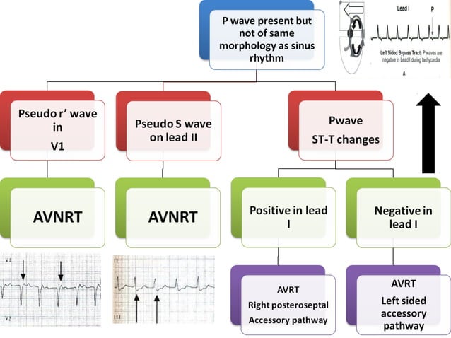 SVT-Alogarythm | PPT