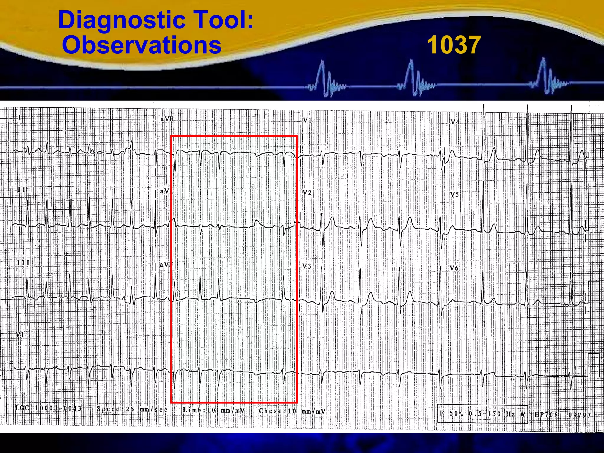 The ECG as a Diagnostic Tool: A Clinical Case Study of Supraventricular Tachycardia | PPT