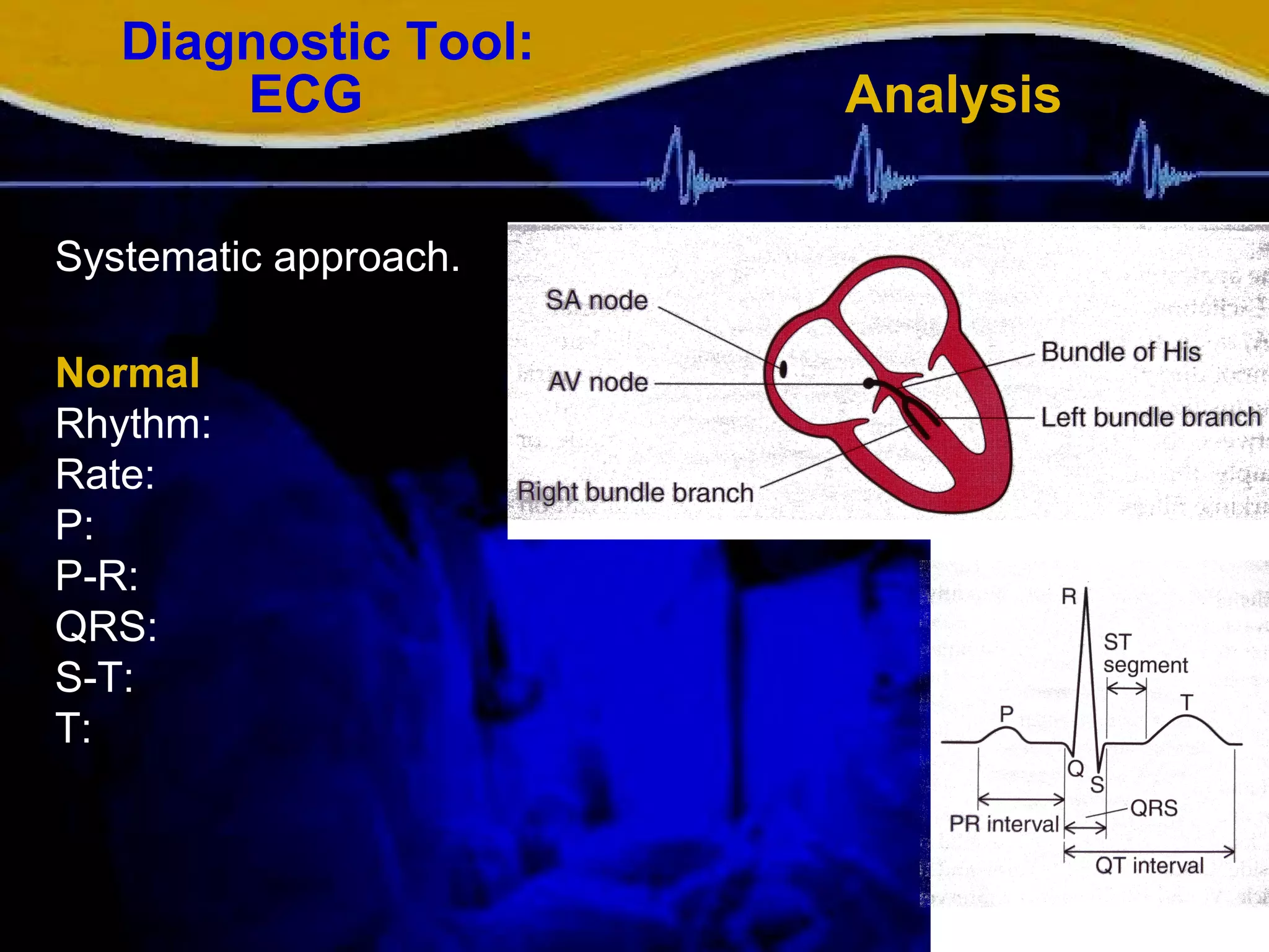 The ECG as a Diagnostic Tool: A Clinical Case Study of Supraventricular ...