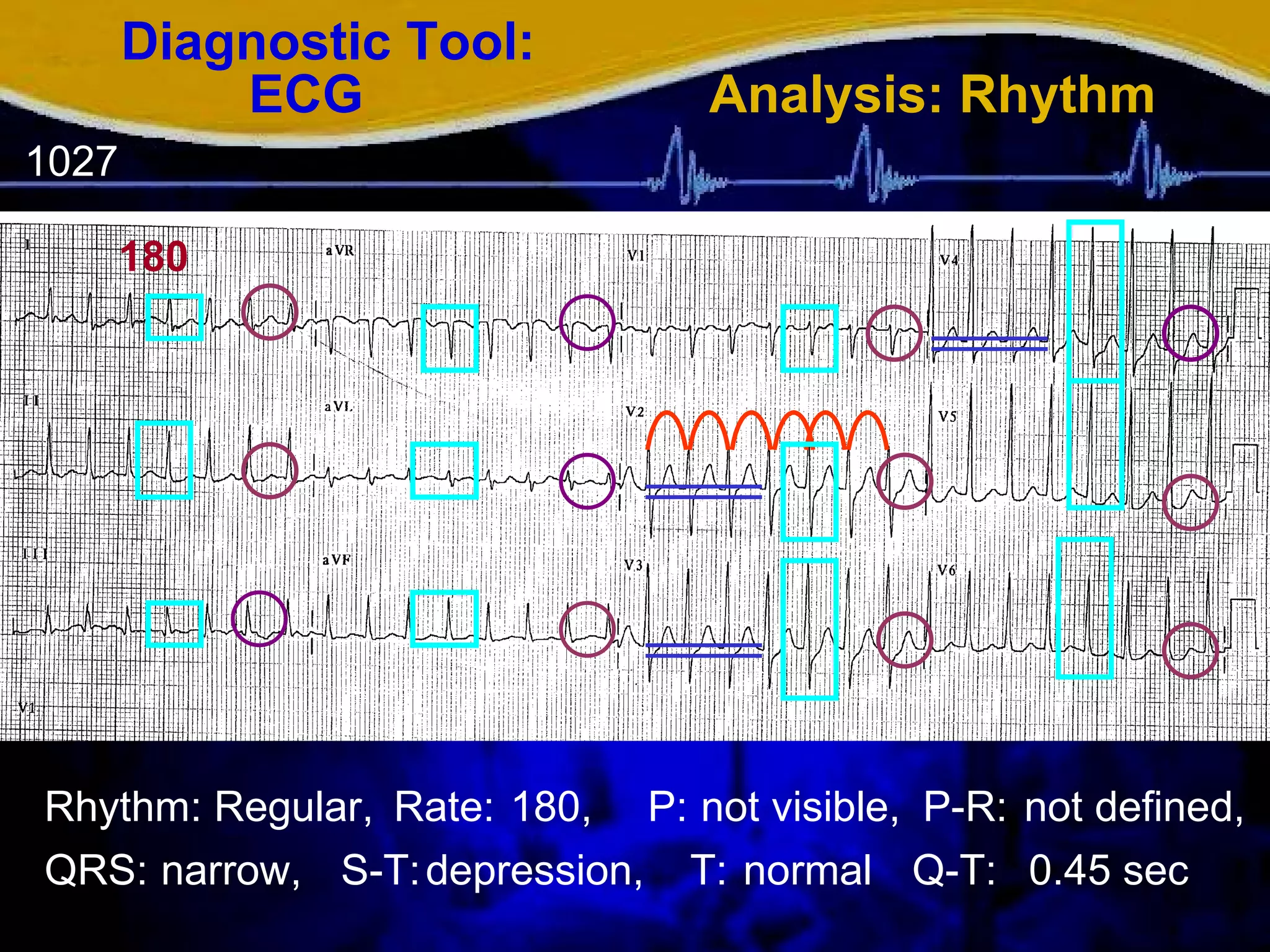 The ECG as a Diagnostic Tool: A Clinical Case Study of Supraventricular ...