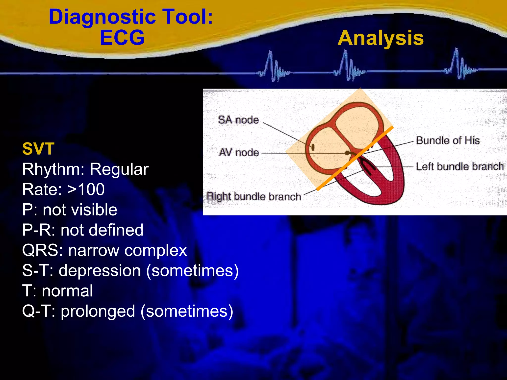 The ECG as a Diagnostic Tool: A Clinical Case Study of Supraventricular Tachycardia | PPT