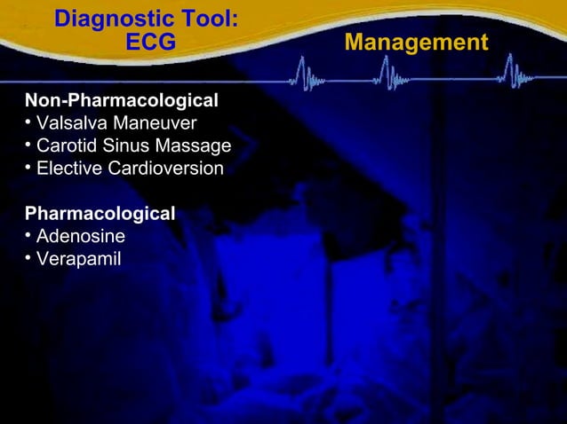 The ECG as a Diagnostic Tool: A Clinical Case Study of Supraventricular Tachycardia | PPT