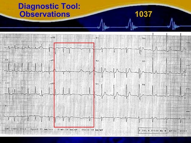 The ECG as a Diagnostic Tool: A Clinical Case Study of Supraventricular ...