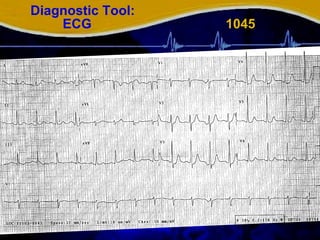The ECG as a Diagnostic Tool: A Clinical Case Study of Supraventricular Tachycardia | PPT