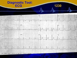 The ECG as a Diagnostic Tool: A Clinical Case Study of Supraventricular Tachycardia | PPT