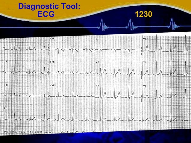 The ECG as a Diagnostic Tool: A Clinical Case Study of Supraventricular ...