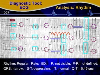 The ECG as a Diagnostic Tool: A Clinical Case Study of Supraventricular Tachycardia | PPT
