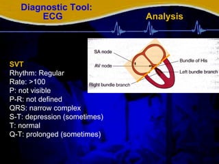 The ECG as a Diagnostic Tool: A Clinical Case Study of Supraventricular ...
