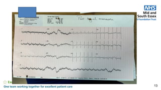SVT presentation in children with ecg pictures | PPTX