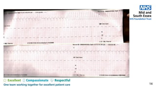 SVT presentation in children with ecg pictures | PPTX