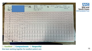 SVT presentation in children with ecg pictures | PPTX
