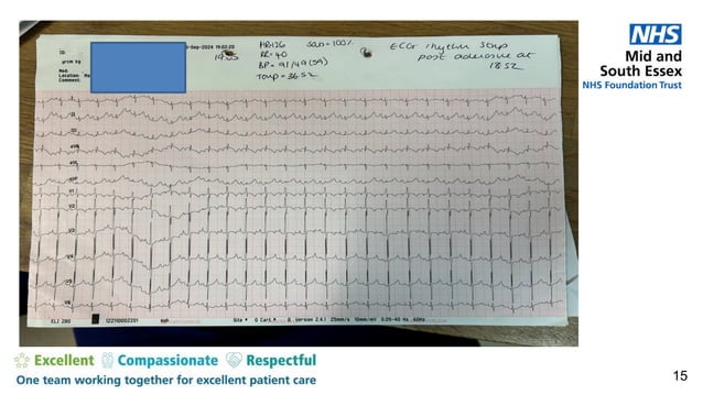 SVT presentation in children with ecg pictures | PPTX