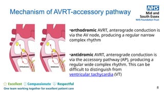SVT presentation in children with ecg pictures | PPTX