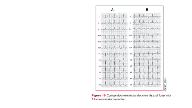 rangkuman guidelines ESC tentang supraventrikular tachycardia | PPT