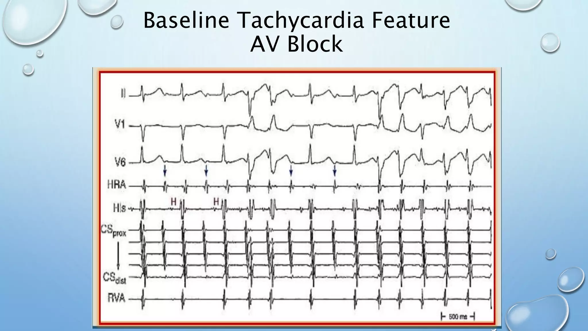SVT maneuvers | PPTX