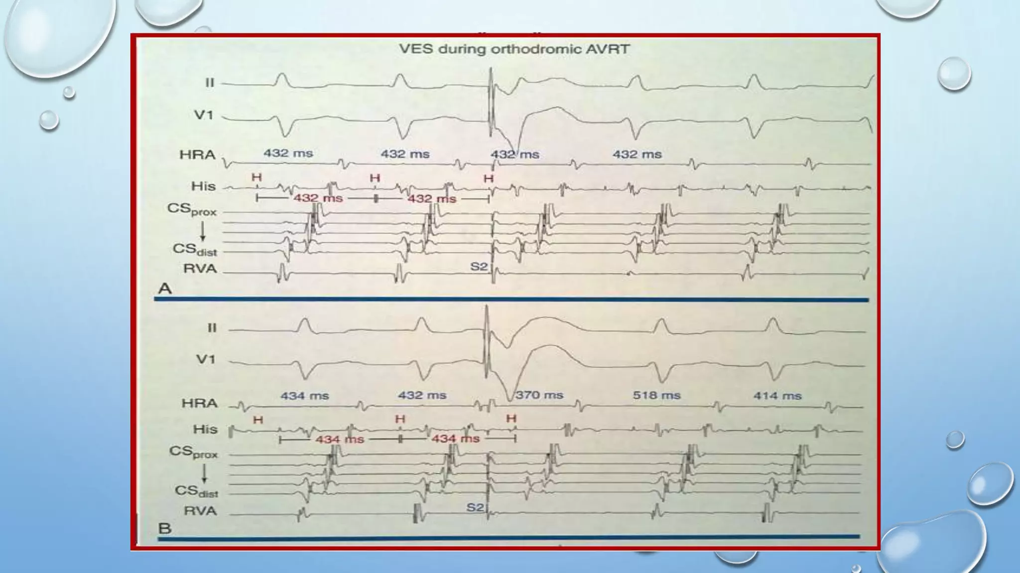 SVT maneuvers | PPTX