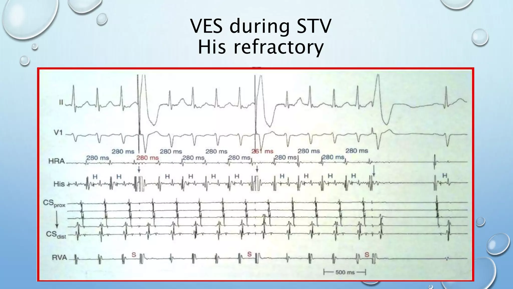 SVT maneuvers | PPTX