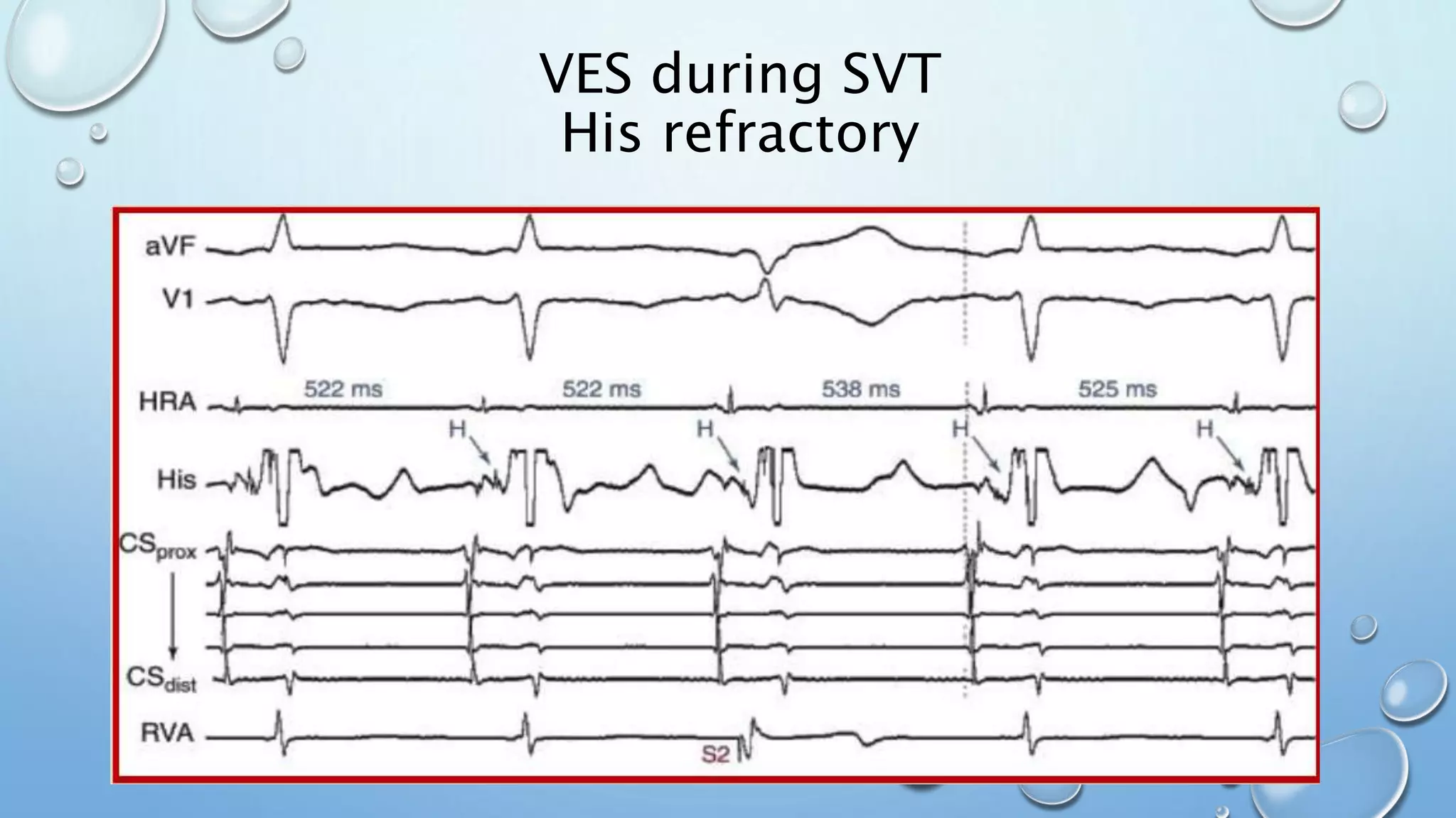 SVT maneuvers | PPTX