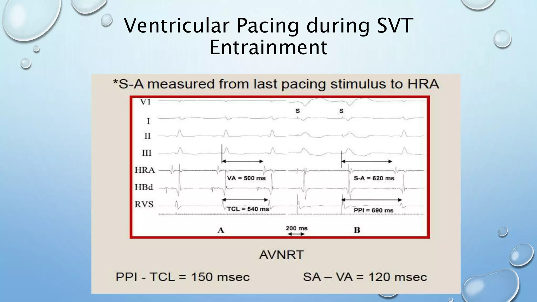SVT maneuvers | PPTX