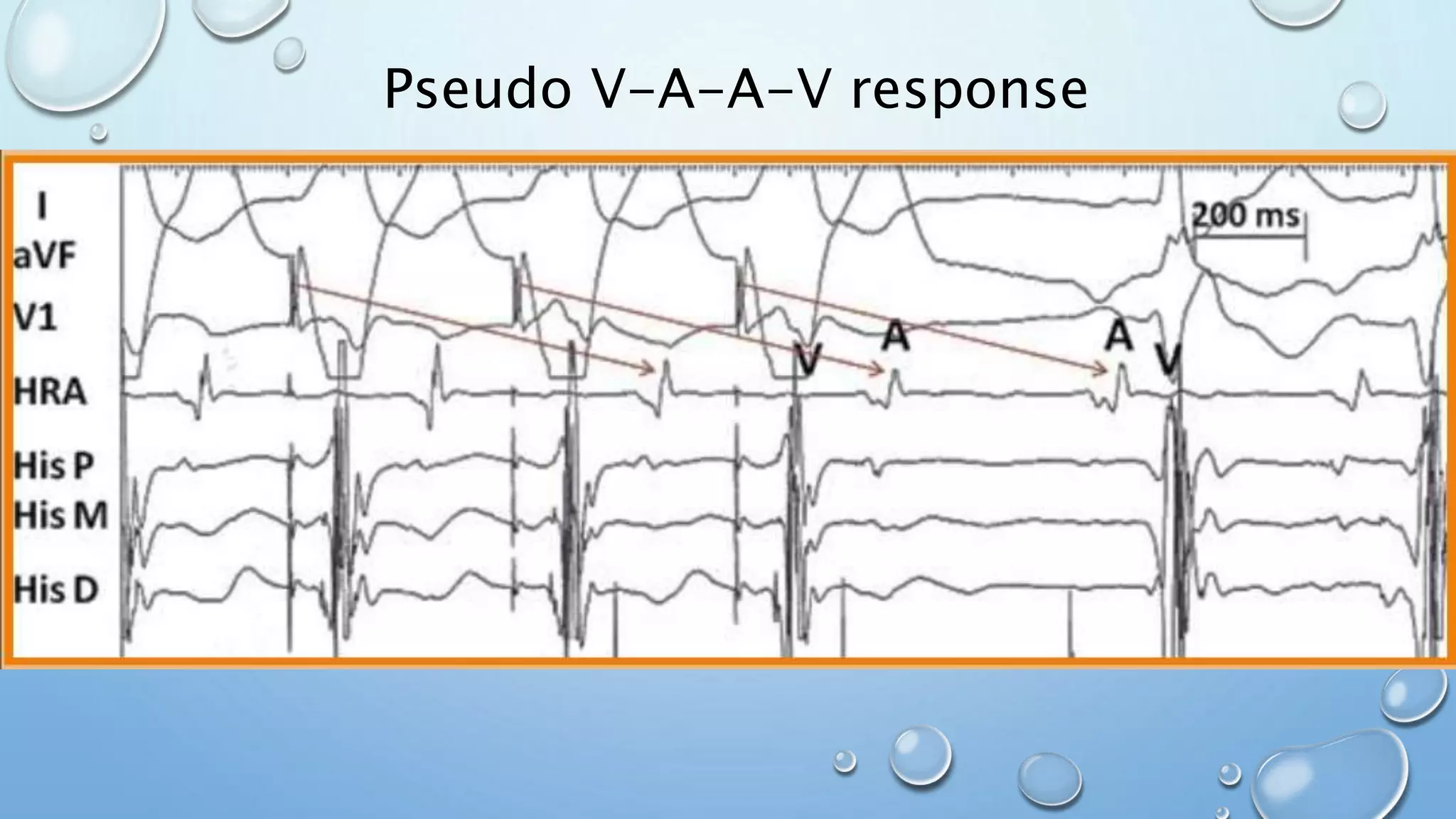 SVT maneuvers | PPTX