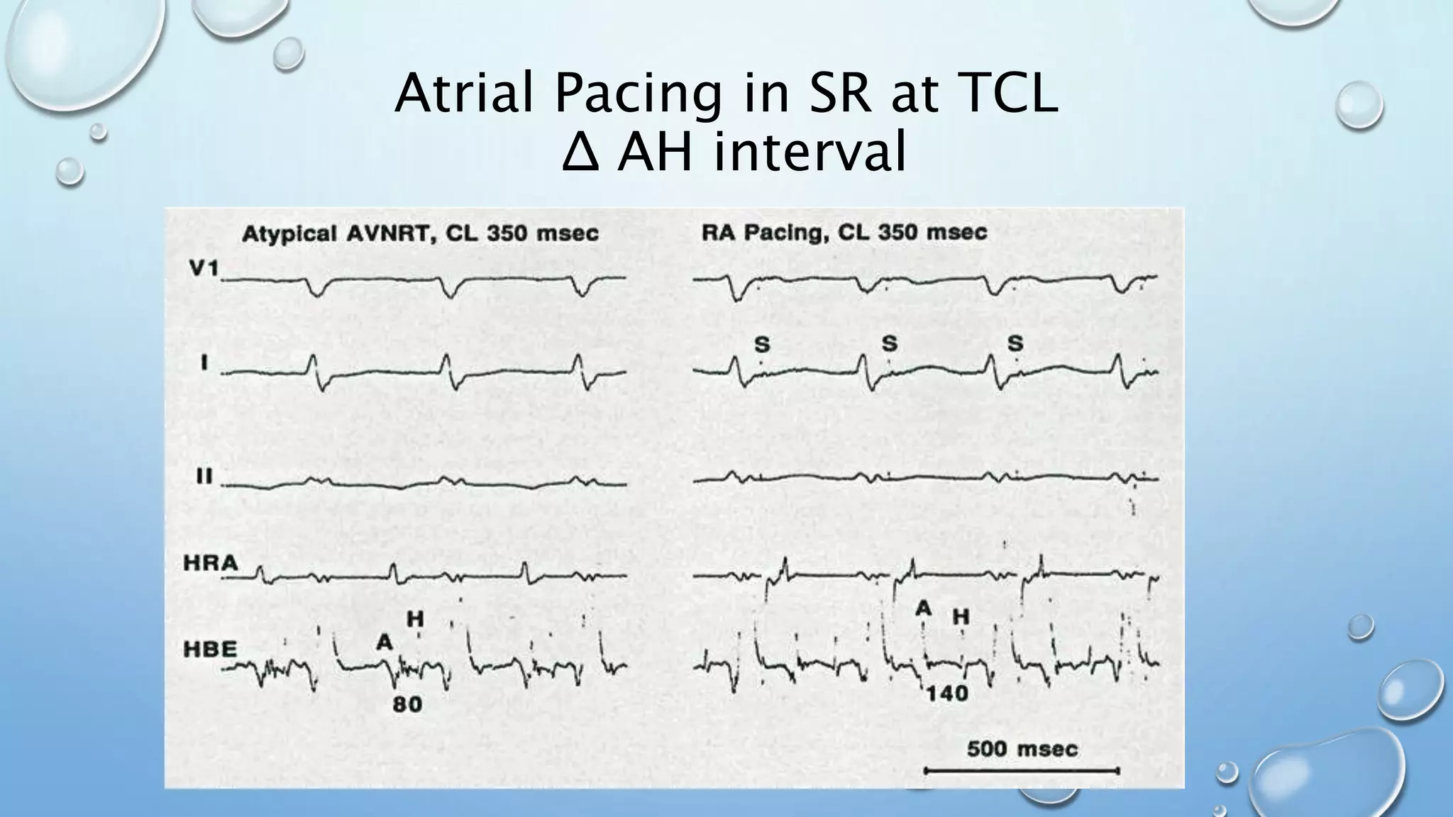 SVT maneuvers | PPTX