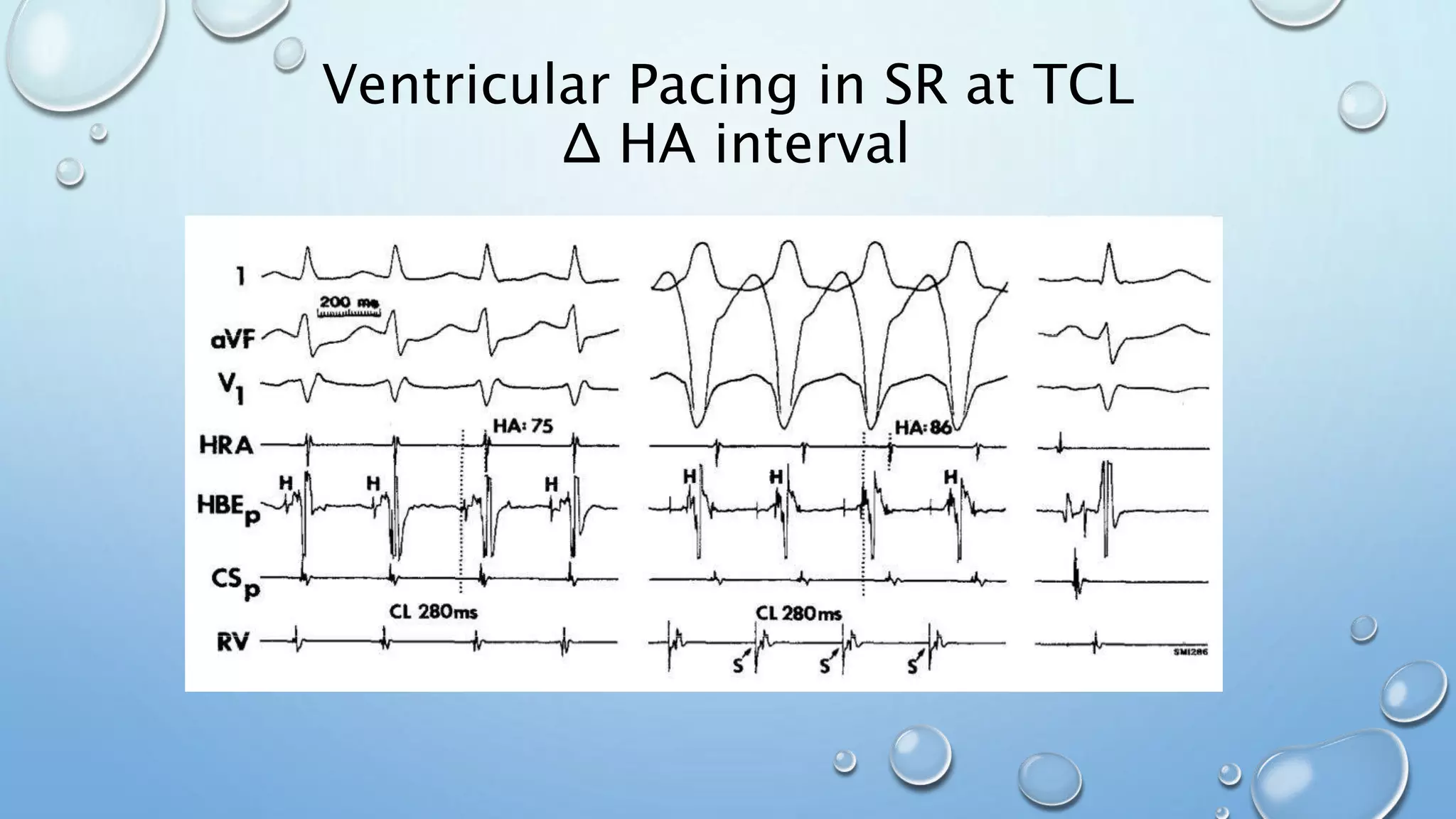 SVT maneuvers | PPTX