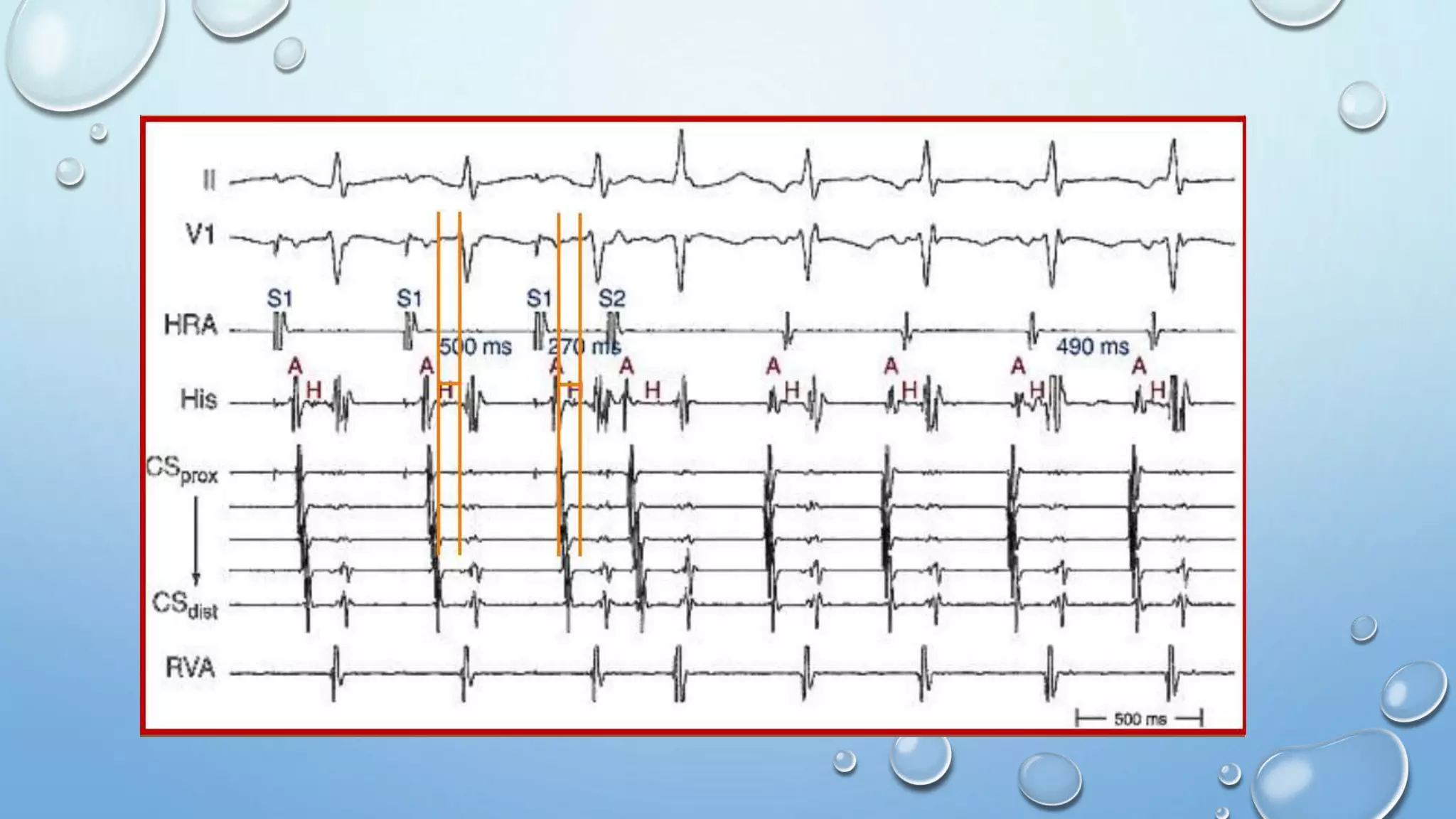 SVT maneuvers | PPTX