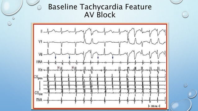 SVT maneuvers | PPTX | Heart and Cardiovascular Diseases | Diseases and ...