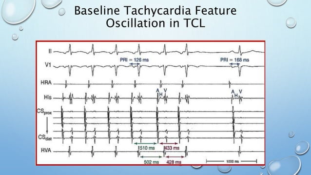 SVT maneuvers | PPTX | Heart and Cardiovascular Diseases | Diseases and ...
