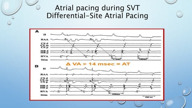 SVT maneuvers | PPTX | Heart and Cardiovascular Diseases | Diseases and ...