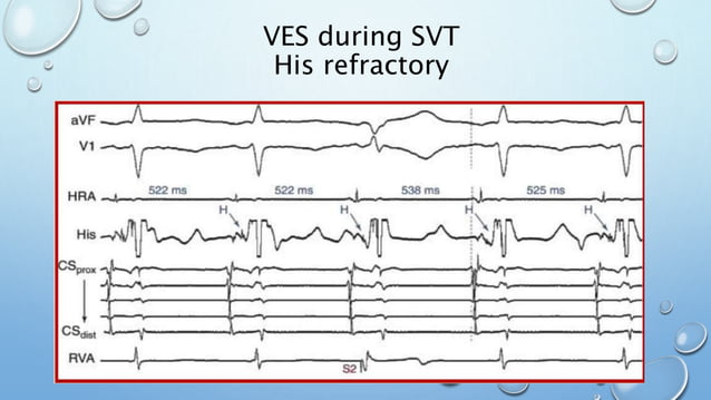 SVT maneuvers | PPTX | Heart and Cardiovascular Diseases | Diseases and ...
