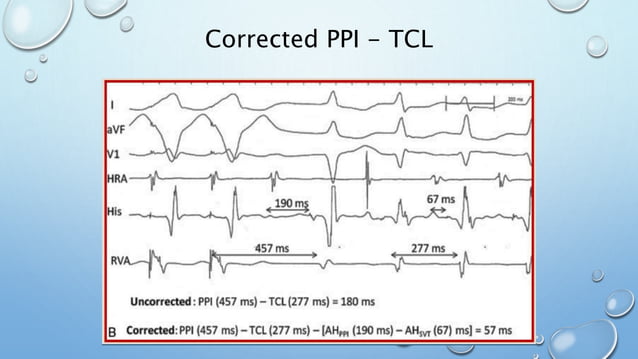SVT maneuvers | PPTX | Heart and Cardiovascular Diseases | Diseases and ...