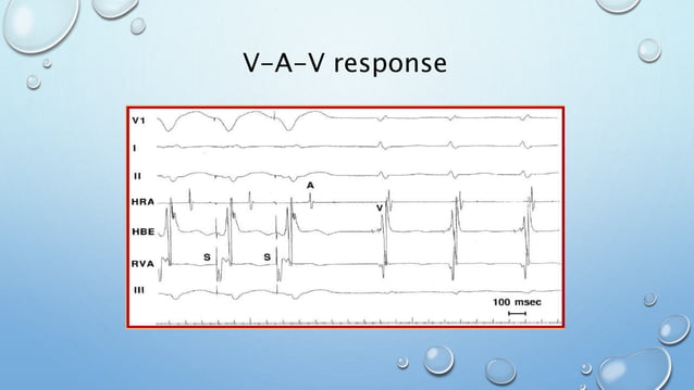 SVT maneuvers | PPTX | Heart and Cardiovascular Diseases | Diseases and ...