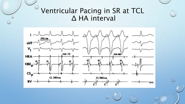 SVT maneuvers | PPTX | Heart and Cardiovascular Diseases | Diseases and ...