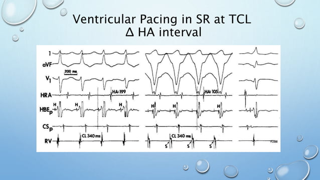 SVT maneuvers | PPTX | Heart and Cardiovascular Diseases | Diseases and ...