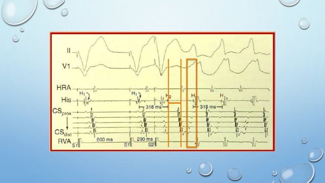 SVT maneuvers | PPTX | Heart and Cardiovascular Diseases | Diseases and ...