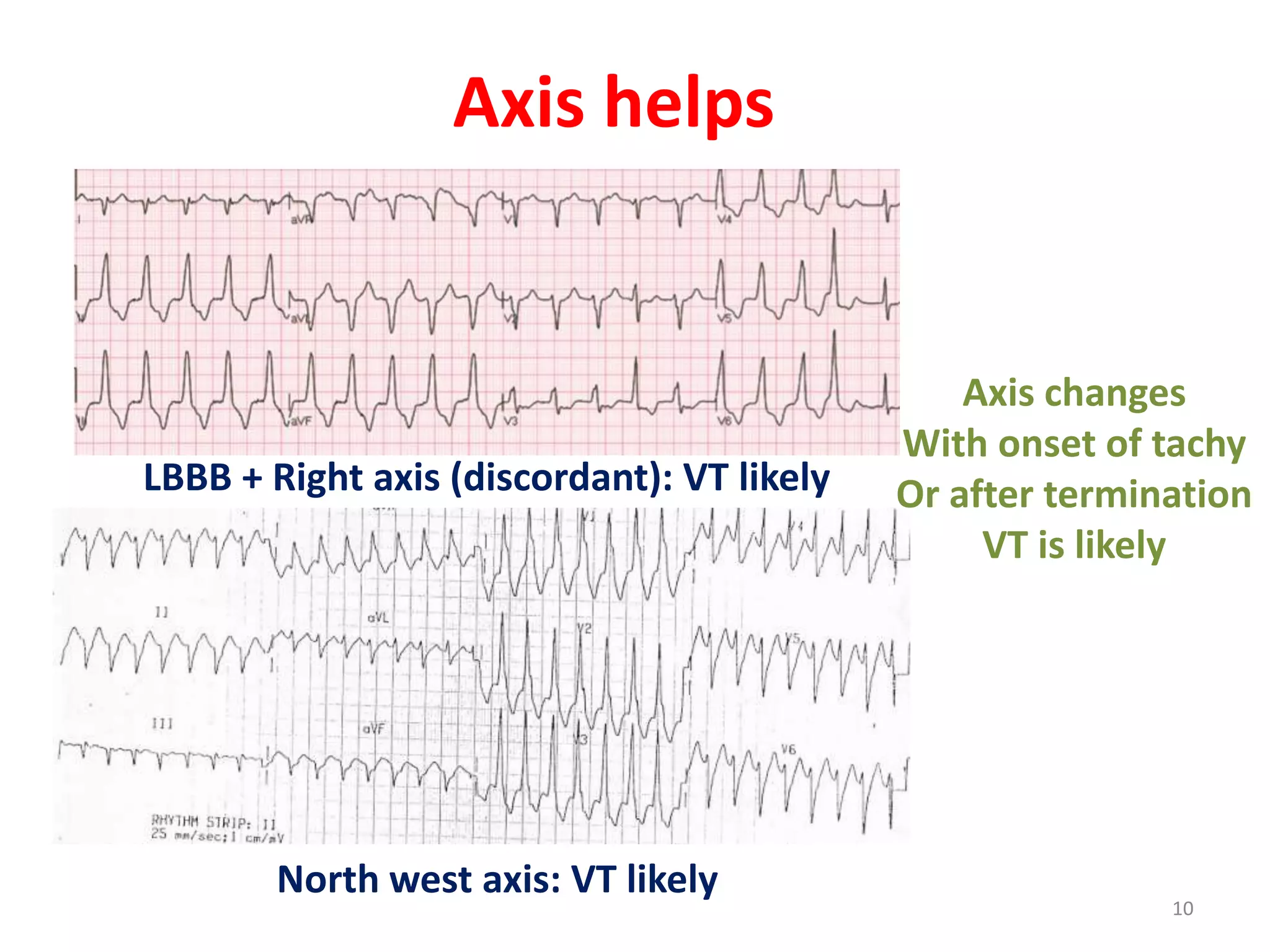 Supraventricular tachycardia: ECG recognition and diagnosis | PPTX