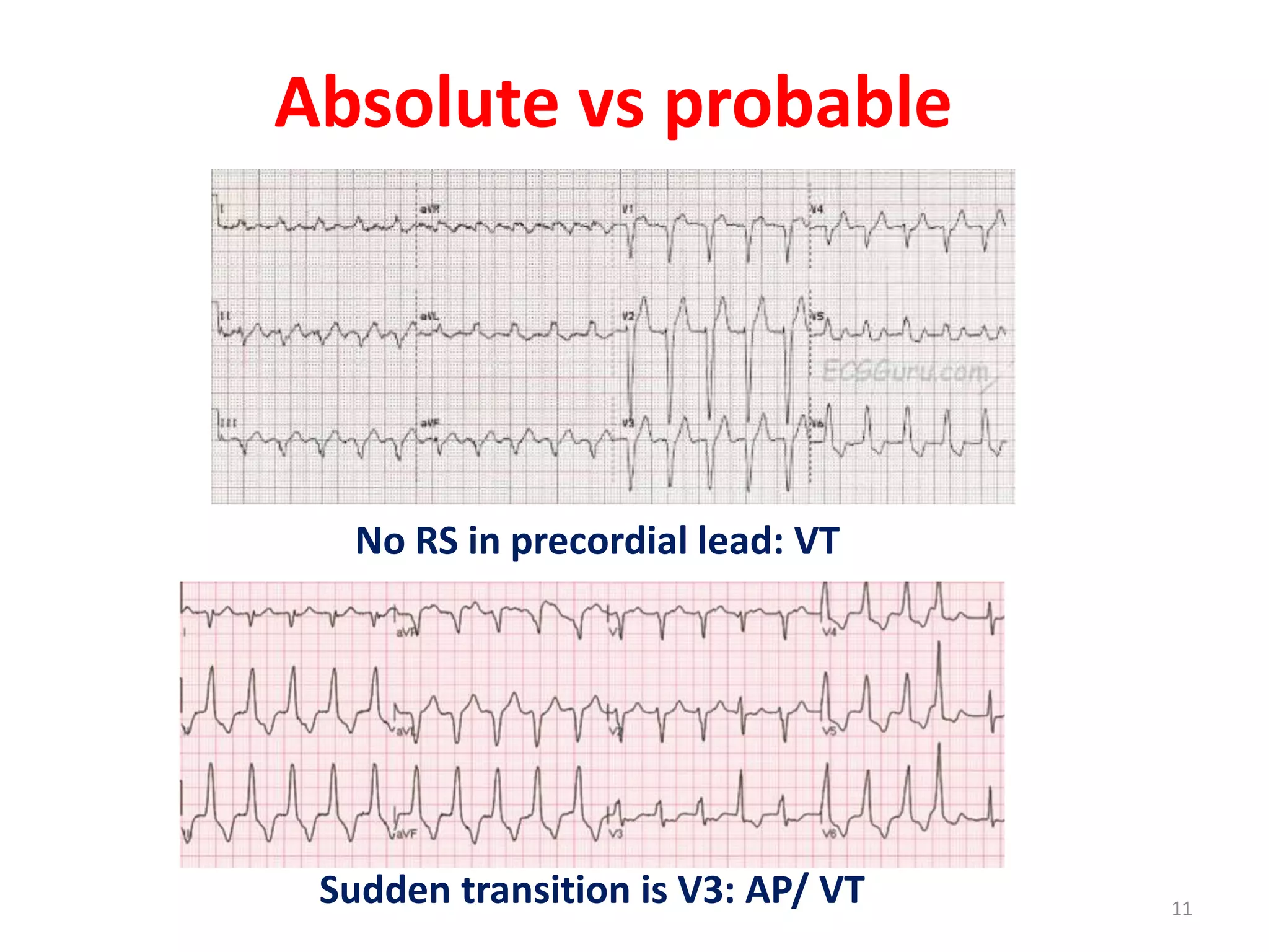 Supraventricular tachycardia: ECG recognition and diagnosis | PPTX