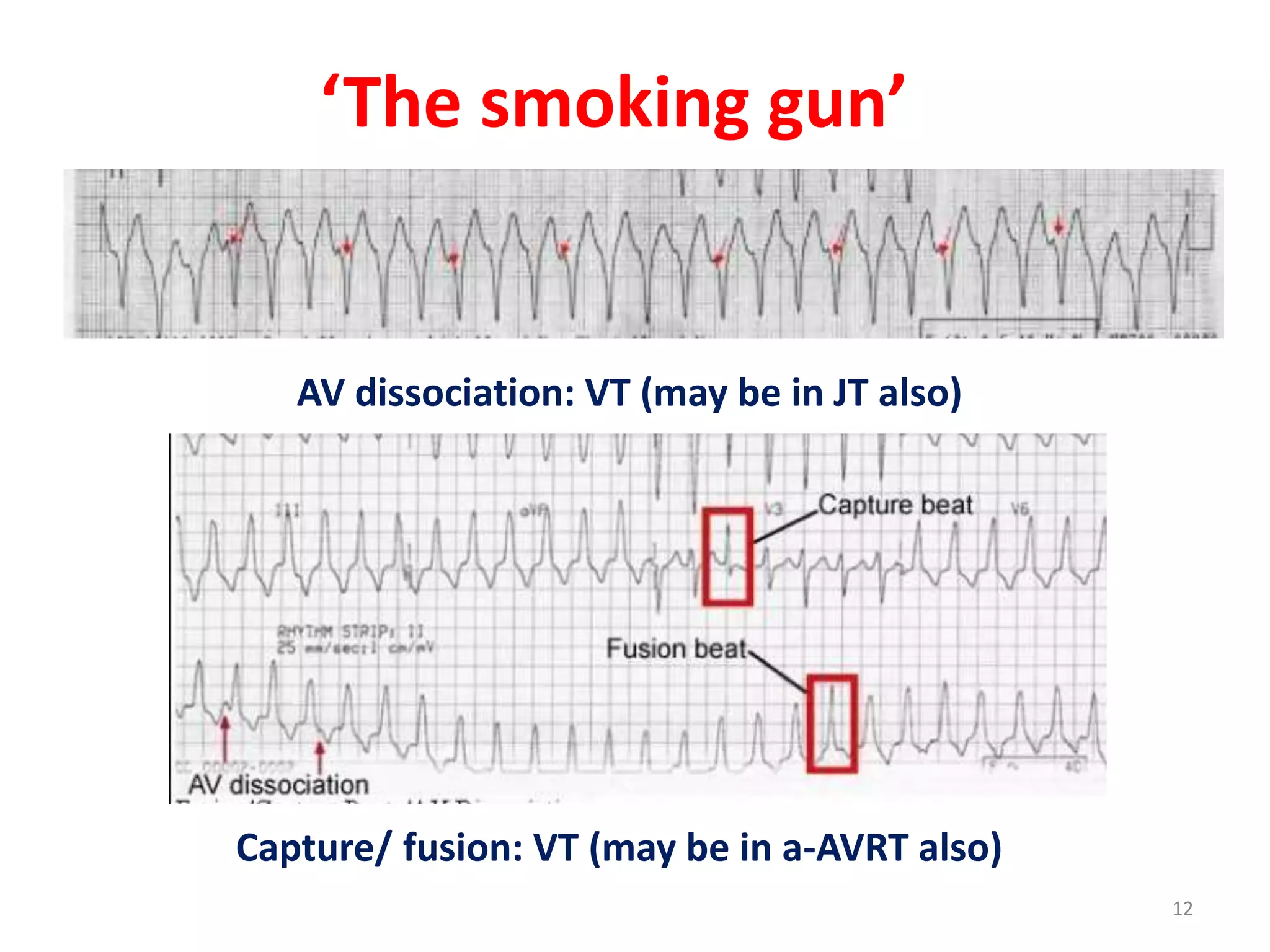 Supraventricular tachycardia: ECG recognition and diagnosis | PPTX